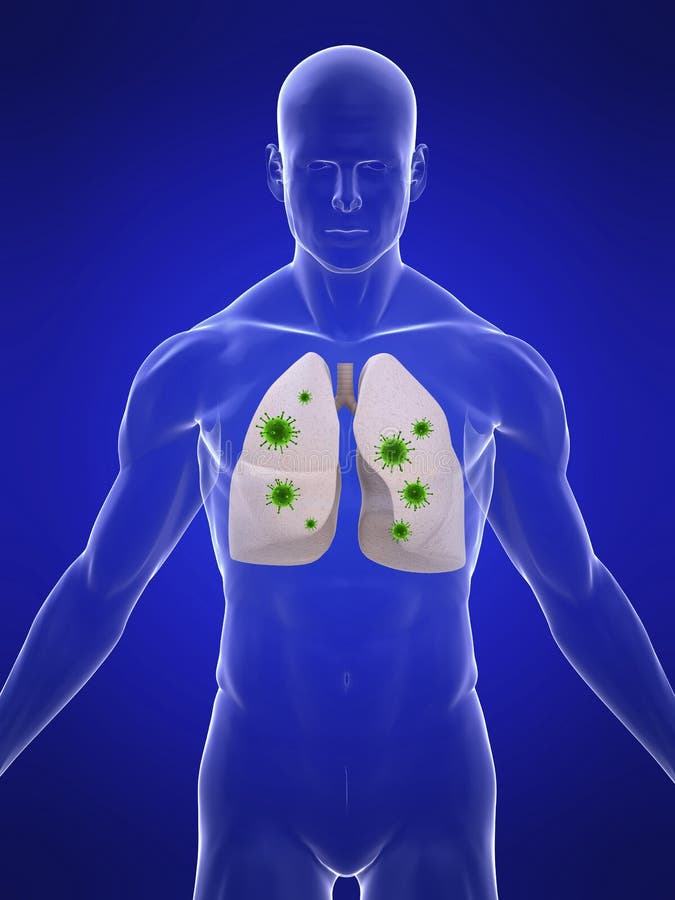 Lung infection stock illustration. Illustration of infection - 11734319