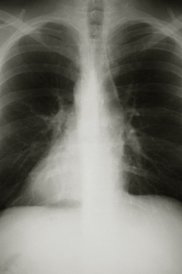 Lung x-ray stock image. Image of doctor, examination, computerized - 756531