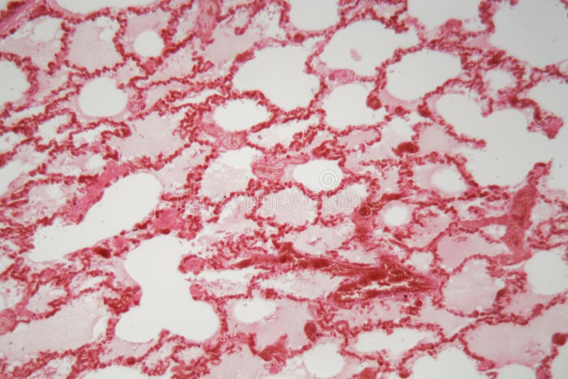 Lung Tissue with Pneumonia Infection Caused by Flu Viral Pneumonia ...