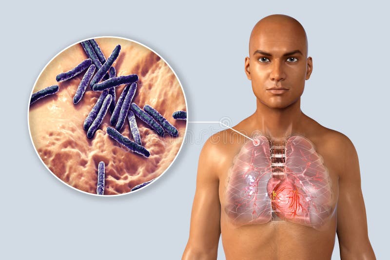 Lung Tuberculosis and Close-up View of Bacteria Mycobacterium ...