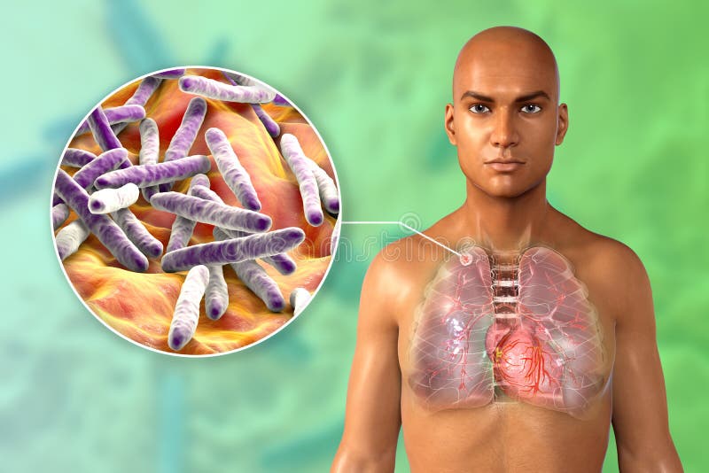 Lung Tuberculosis and Close-up View of Bacteria Mycobacterium ...