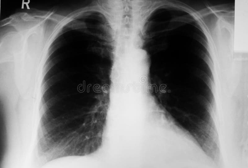 Lung xray stock photo. Image of scan, body, human, radiography - 23835088