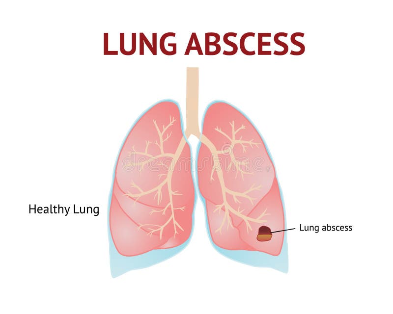 Lung Abscess Stock Illustrations – 91 Lung Abscess Stock Illustrations ...