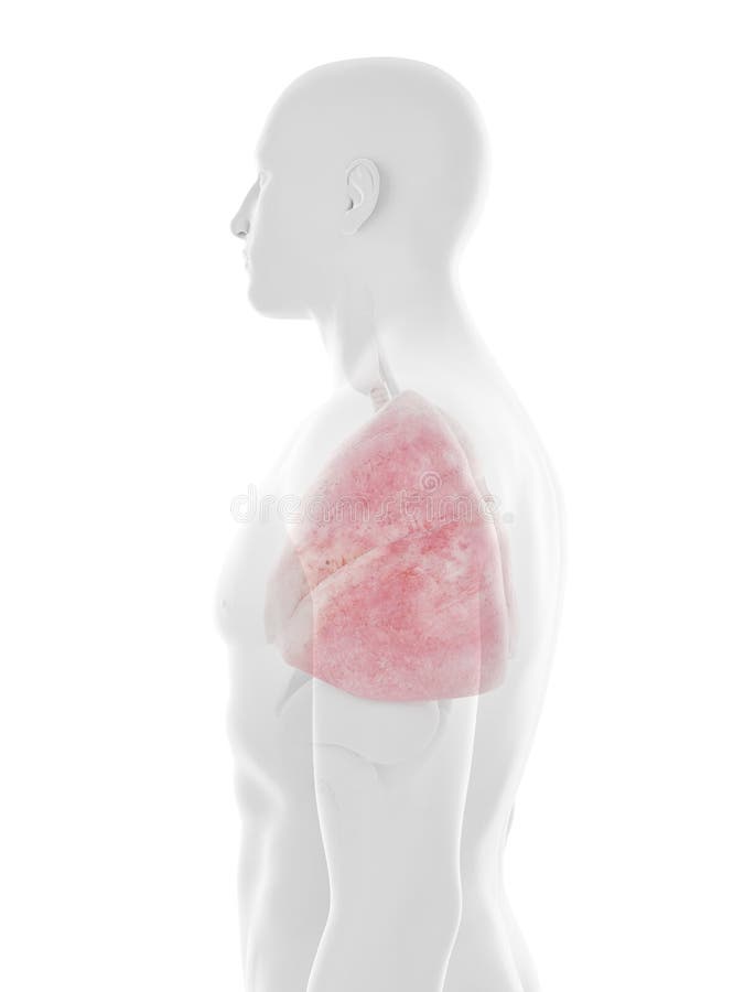 Cystic Fibrosis Lungs Stock Illustrations 569 Cystic Fibrosis Lungs
