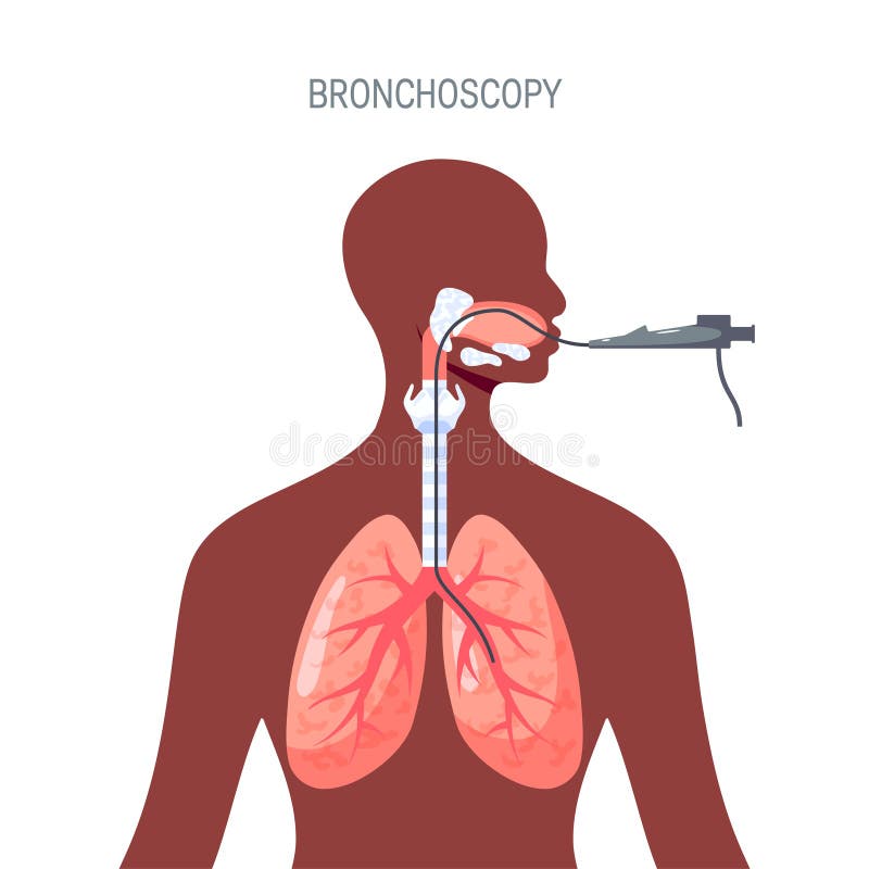 Bronchoscopy Vector Stock Illustrations – 185 Bronchoscopy Vector Stock ...