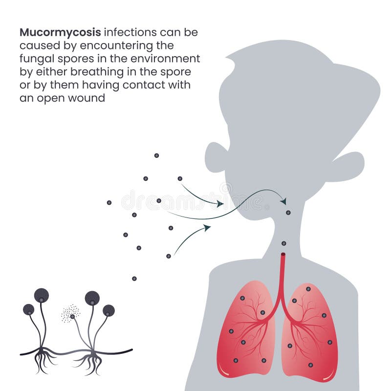 Mucormycosis Black Fungus Infection in the Lungs through Inhaled Spores ...
