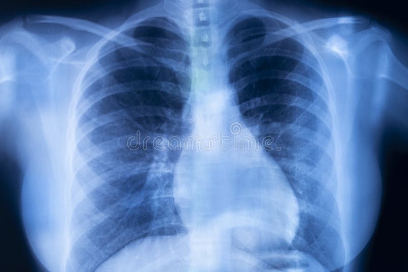 Lungs ribs xray scan stock image. Image of care, medical - 215490939