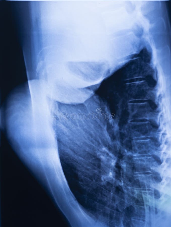 Lungs ribs xray scan stock image. Image of medical, medicine - 227923187