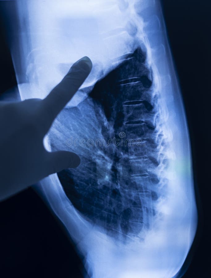 Lungs ribs xray scan stock photo. Image of pulmonary - 227923188