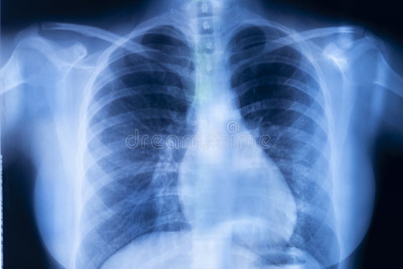 Lungs ribs xray scan stock image. Image of radiograph - 230985473