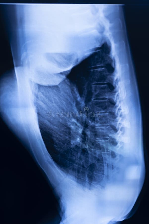 Lungs ribs xray scan stock photo. Image of patient, lung - 232037414