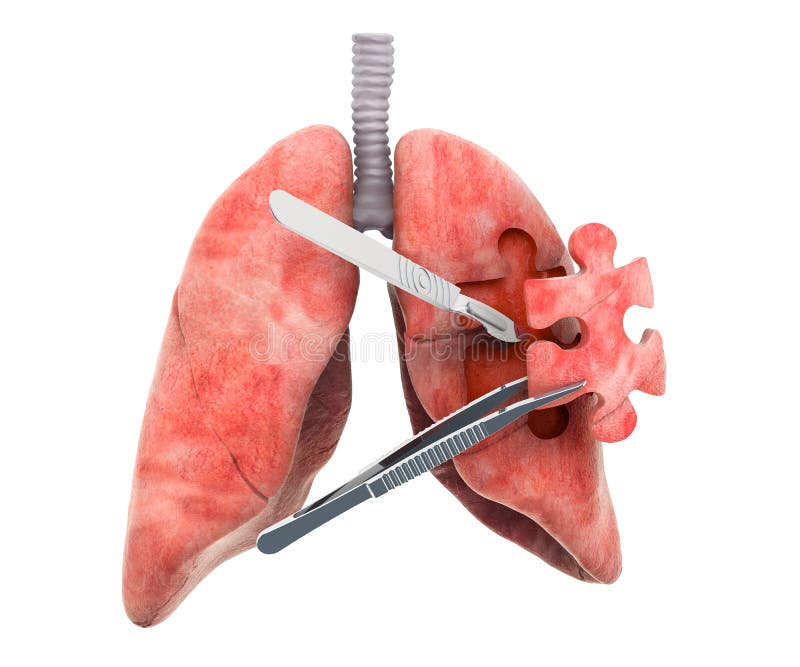 Lungs Operation (medicine Puzzle Concept) Stock Illustration ...