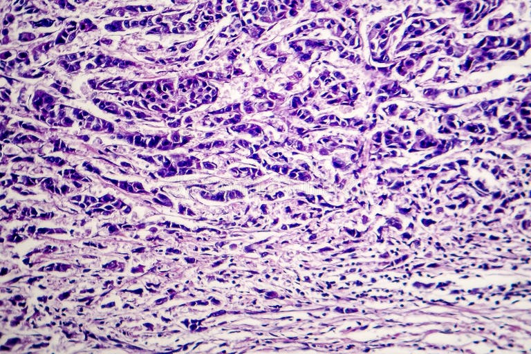 873 Lymph Node Picture Stock Photos - Free & Royalty-Free Stock Photos ...