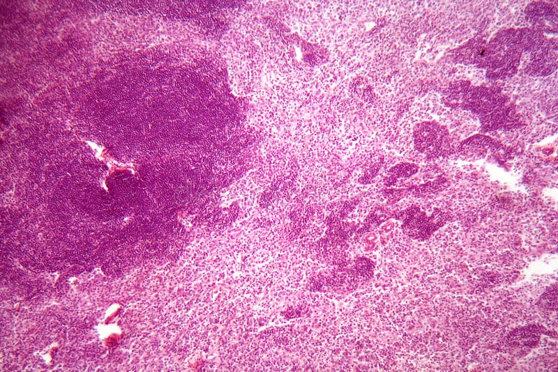 Lymph Node Cells Under the Microscope. Stock Photo - Image of infection ...