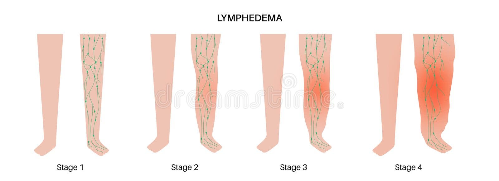 Lymphedema Stages. Lymphatic System Dysfunction Disease Stock Vector ... Lymphedema Stages. Lymphatic System Dysfunction Disease Stock Vector ...