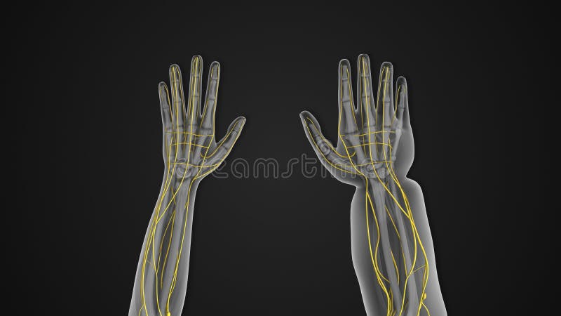Lymphedema Disorder Characterized by Swelling of the Hand Stock ...