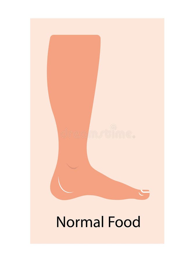 Lymphedema stages. stock illustration. Illustration of genetic - 268808733