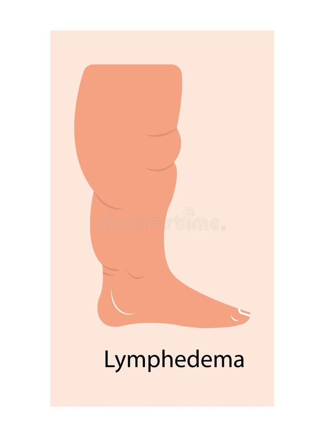 Lymphedema stages stock vector. Illustration of medicine - 268808736