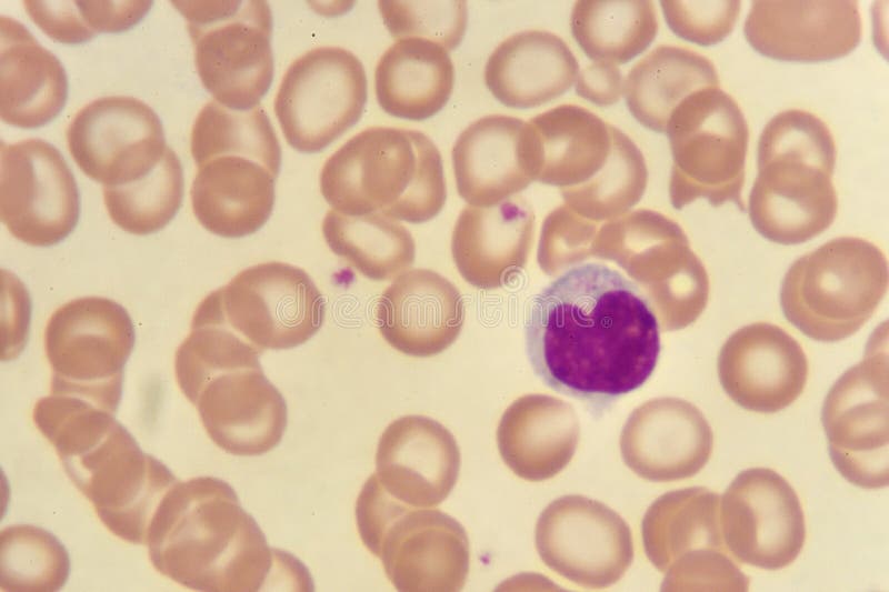 Lymphocyte Cell in Blood Smear Stock Photo - Image of checkup ...