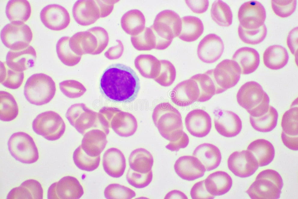 Lymphocyte Cell in Human Blood Smear Stock Image - Image of microcyte ...