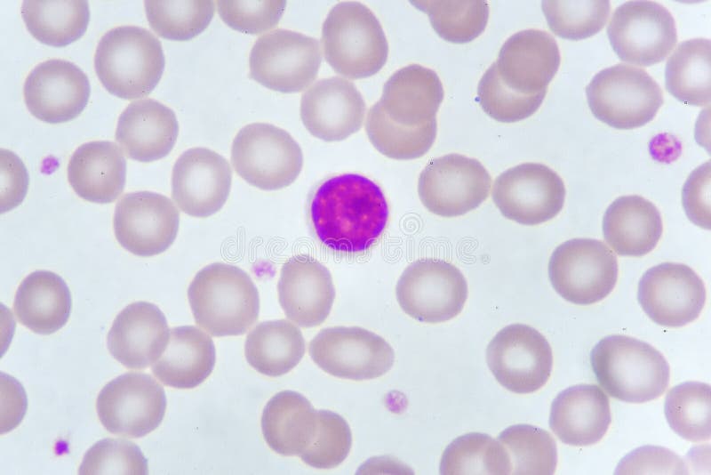 Lymphocyte Cells in Blood Smear Stock Image - Image of care ...