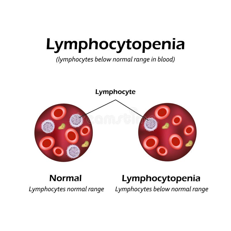 Lymphocytes Below the Normal Range in the Blood. Lymphocytopenia Stock ...