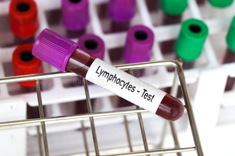 Lymphocytes Test, Blood Sample To Analyze in the Laboratory Stock Photo ...