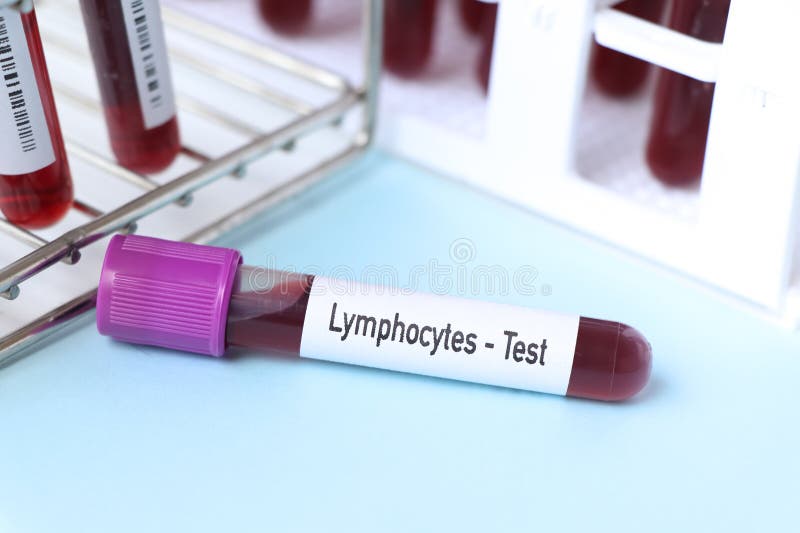 Lymphocytes Test, Blood Sample To Analyze in the Laboratory Stock Photo ...