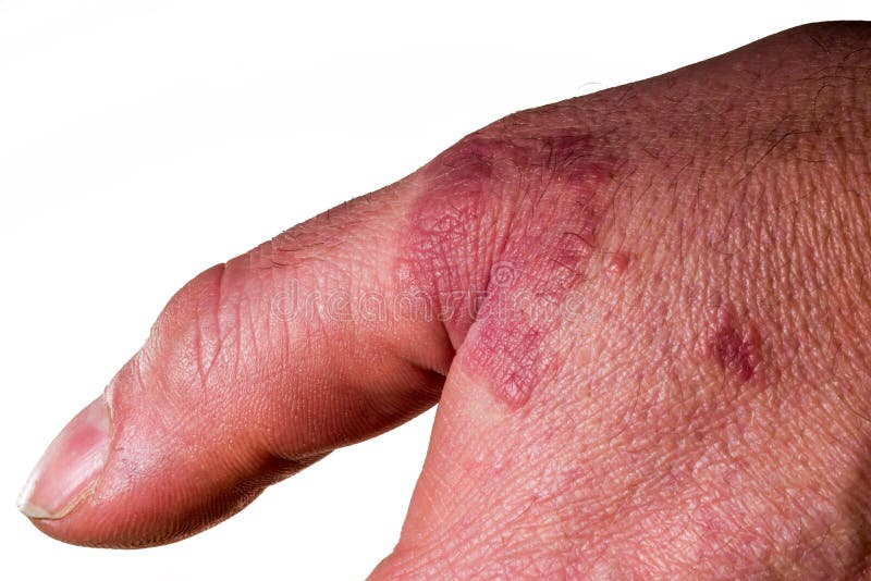 Mão Humana Com Prurido/eczema Imagem de Stock - Imagem de tratamento ...