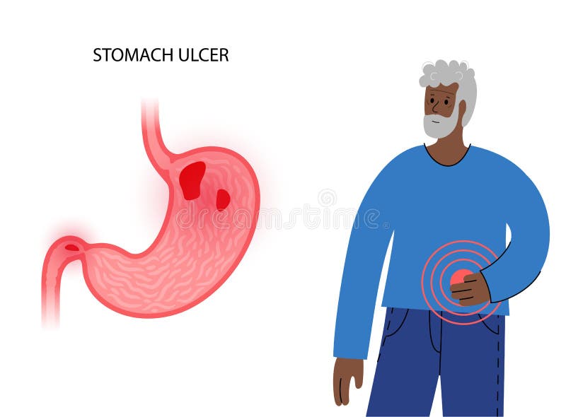 Maagzweer vector illustratie. Illustration of slokdarm - 214773905 Maagzweer vector illustratie. Illustration of slokdarm - 214773905