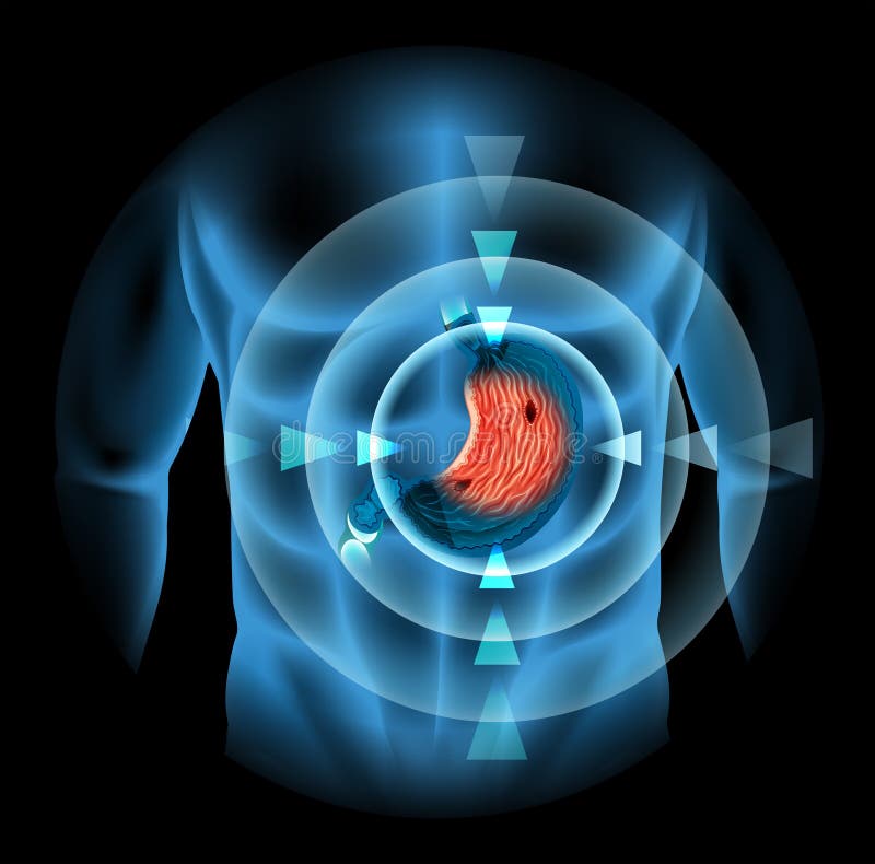 Maagzweer vector illustratie. Illustration of anatomie - 9802874