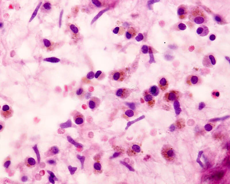 Macrófagos Con La Hemosiderina Imagen de archivo - Imagen de humano ...