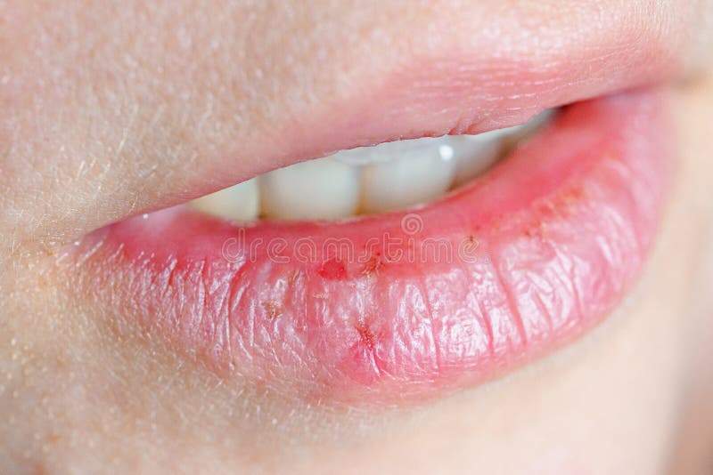 374 Bleeding Mouth Stock Photos - Free & Royalty-Free Stock Photos from ...