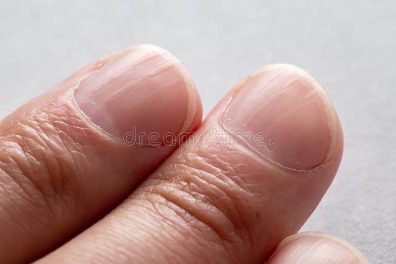 Macro Photo of Vertical Ridges in Fingernails Stock Image - Image of ...