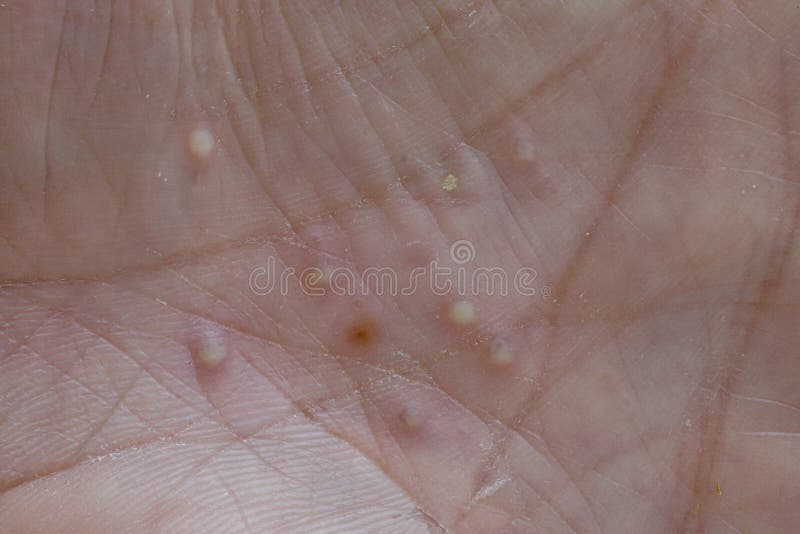 Pustular Psoriasis Lesions on the Left Palm , Palmoplantar Psoriasis ...