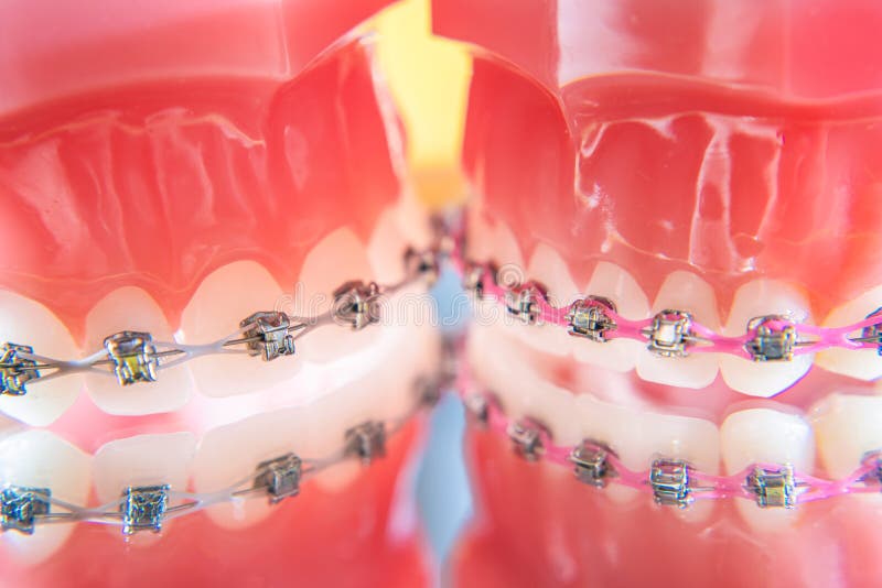 On Macro Photos Shows How the System of Brackets is Arranged Stock ...