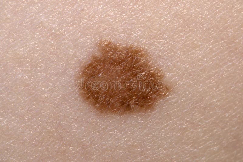 Macro Shot of a Big Skin Mole Stock Photo - Image of cell, displeased ...