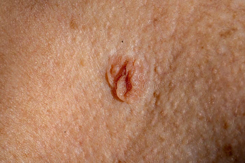 Macro Shot of the Human Skin with a Mark. Stock Photo - Image of health ...