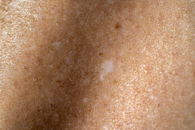 Macro Shot of the Human Skin with Nevi, Moles. Stock Image - Image of ...