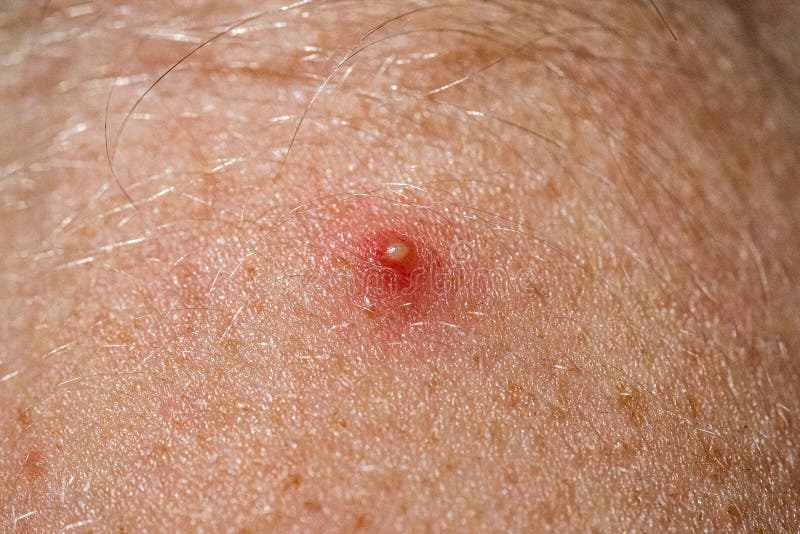 Macro Shot of the Human Skin with a Pimple. Stock Photo - Image of ...