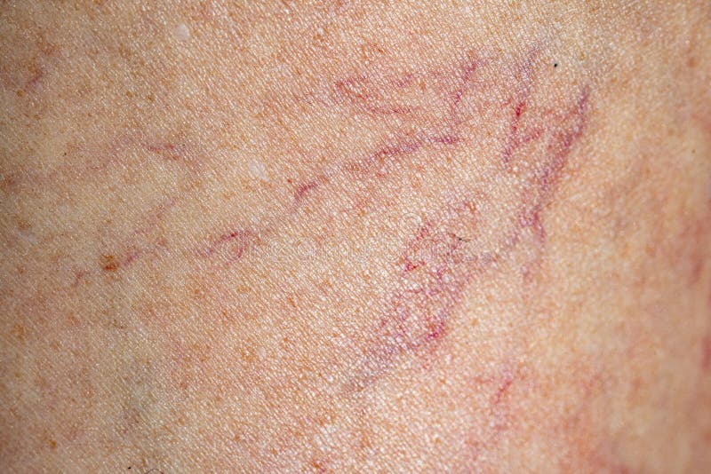 Macro Shot of the Human Skin with Veins. Stock Image - Image of surface ...