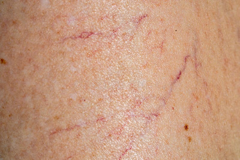 Macro Shot of the Human Skin with Veins. Stock Image - Image of blood ...