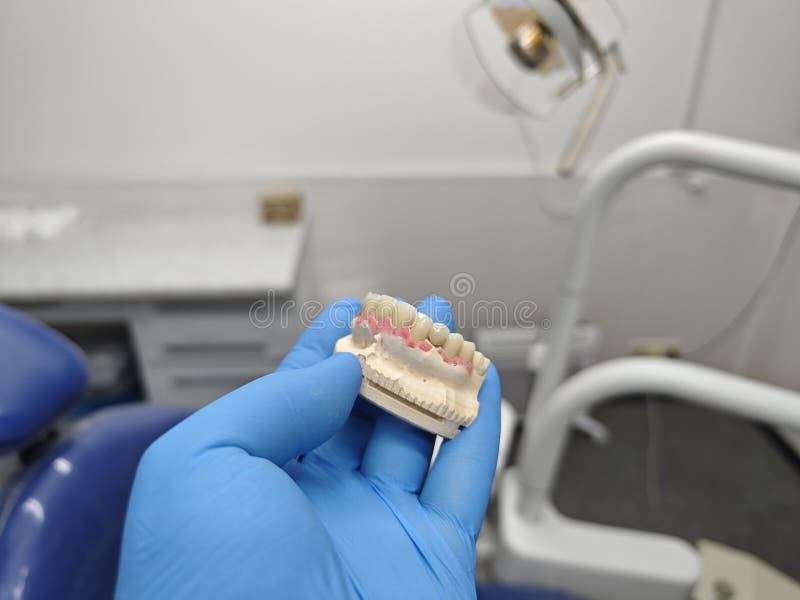 Macro Shot of Single Zirconia Crown in the Plaster Model Stock Photo ...