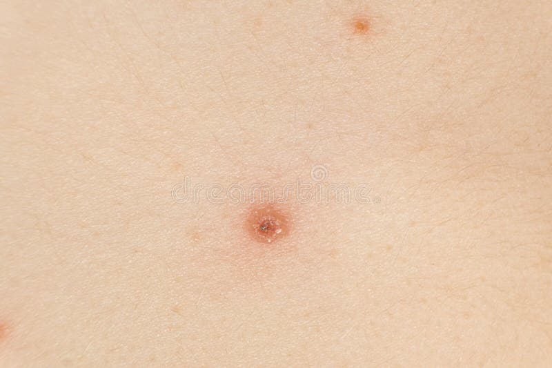 Macro Skin with Chickenpox, Vesicles at Different Stages. Stock Photo ...