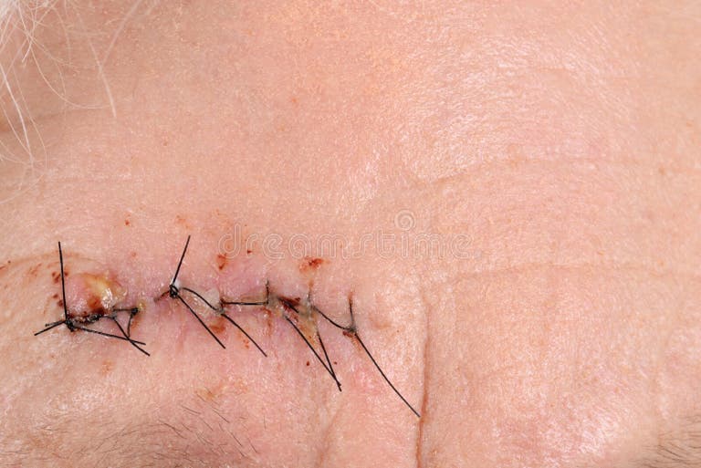 Macro sutures on forehead stock image. Image of operation - 27534925