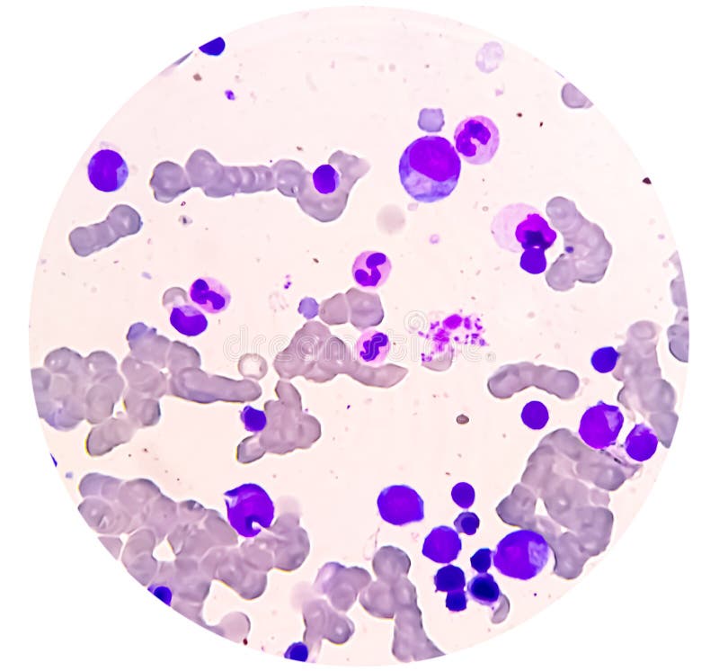 Abnormal white blood cell stock photo. Image of healthcare - 321410508