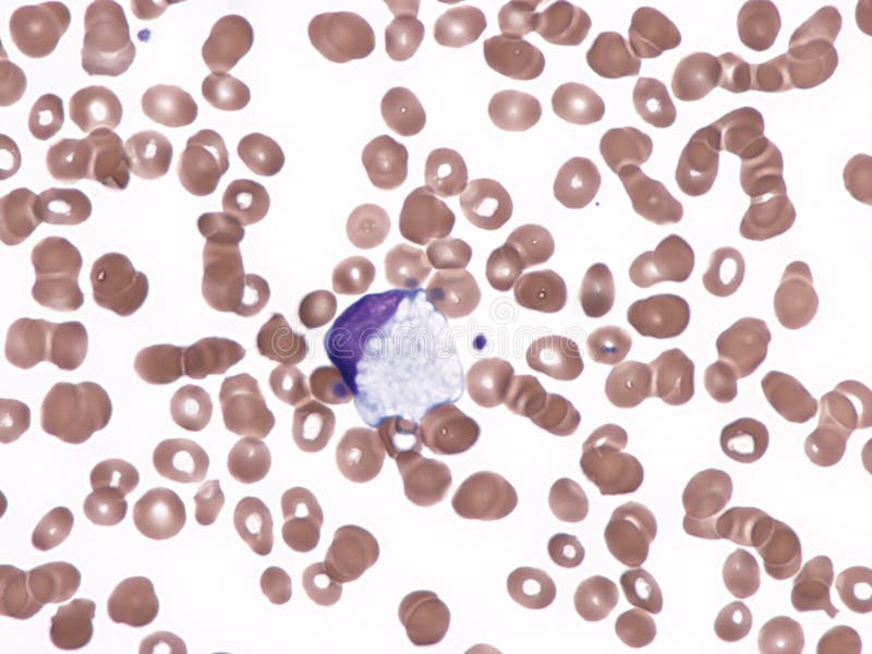 Macrophage in Peripheral Blood. Stock Photo - Image of pathology ...