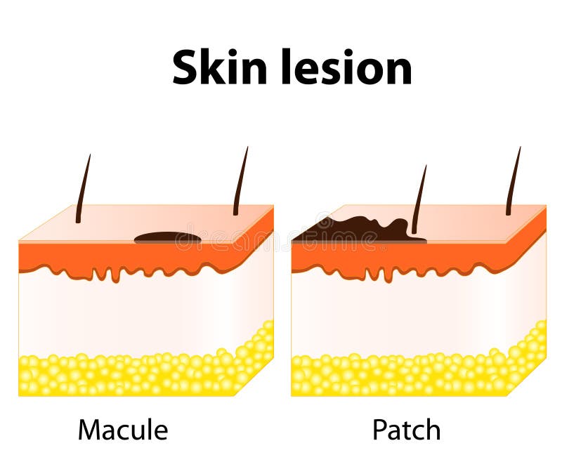 Macule Y Remiendo Tipos De Lesiones De Piel Ilustración del Vector ...
