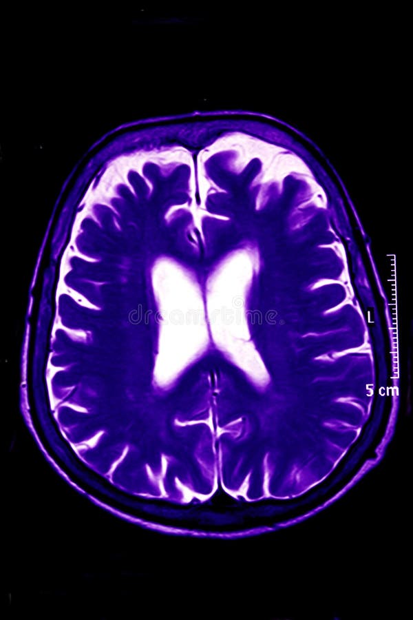 Magnetic Resonance of Brain, Blue MR Stock Photo - Image of body ...