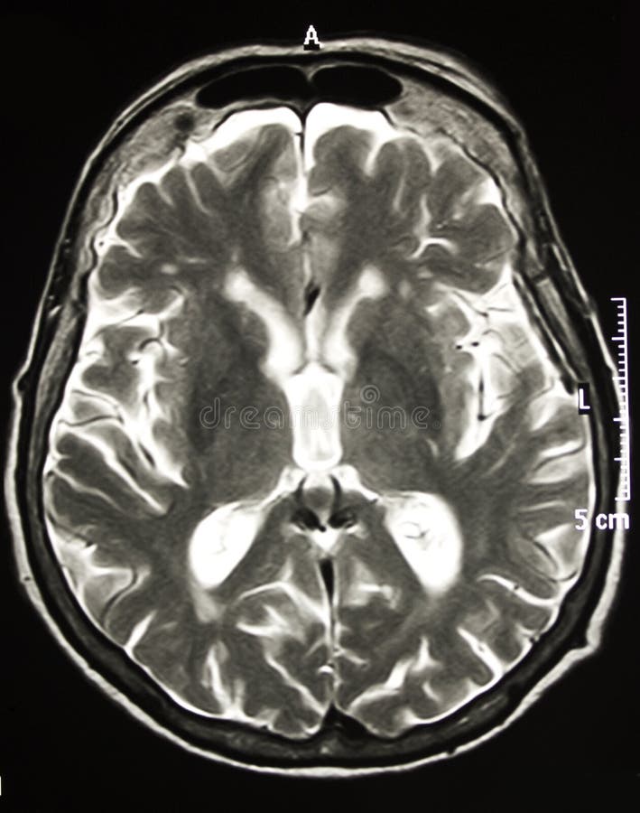 Magnetic Resonance of Brain, Blue MR Stock Image - Image of headache ...